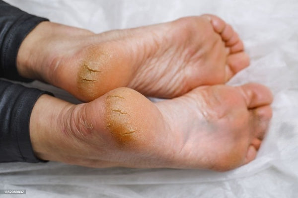 How to Heal Cracked Feet Overnight: A Comprehensive Guide – foottex