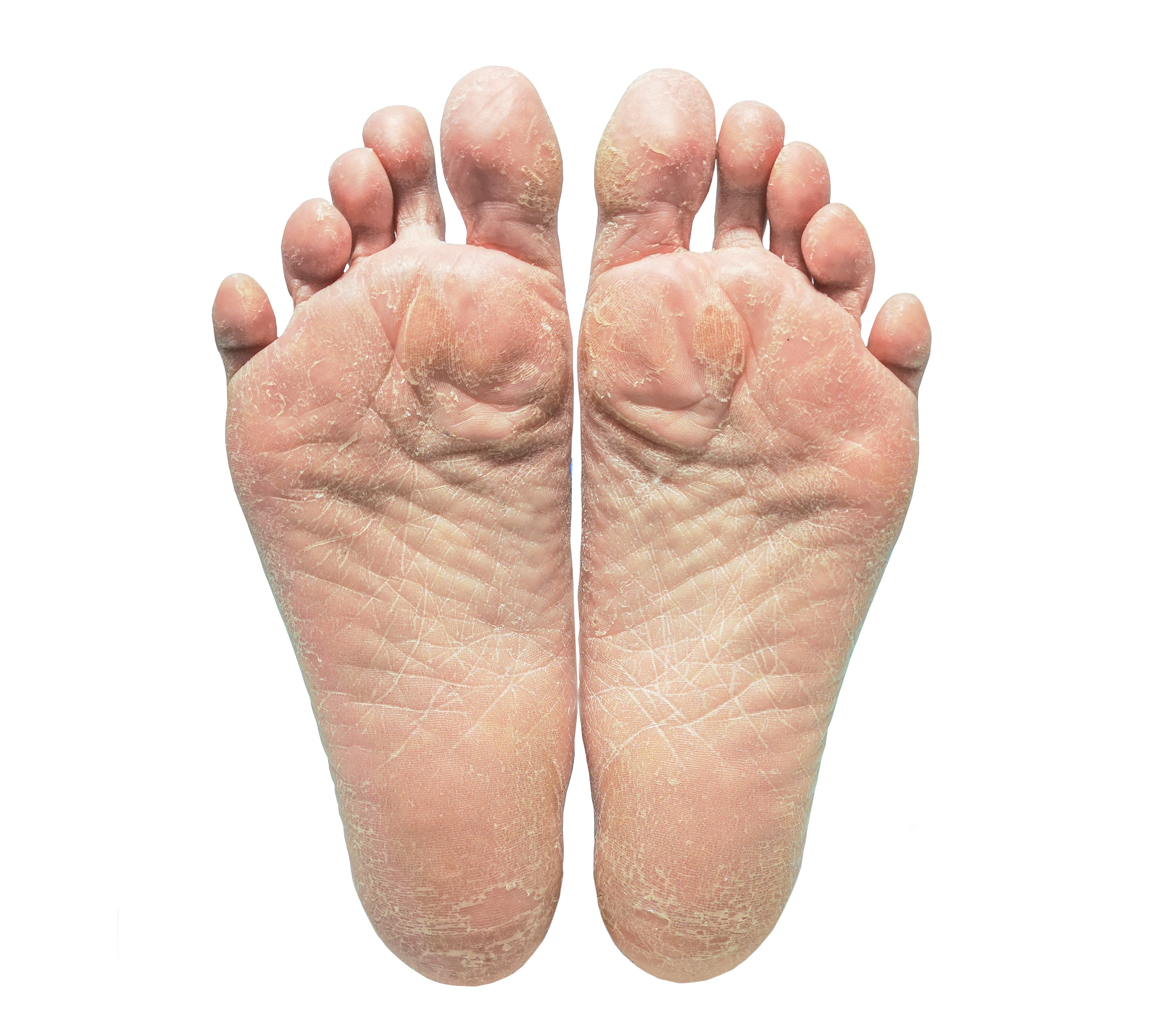 The Ultimate Guide to Addressing Foot Cracks and Problems: Introducing ...